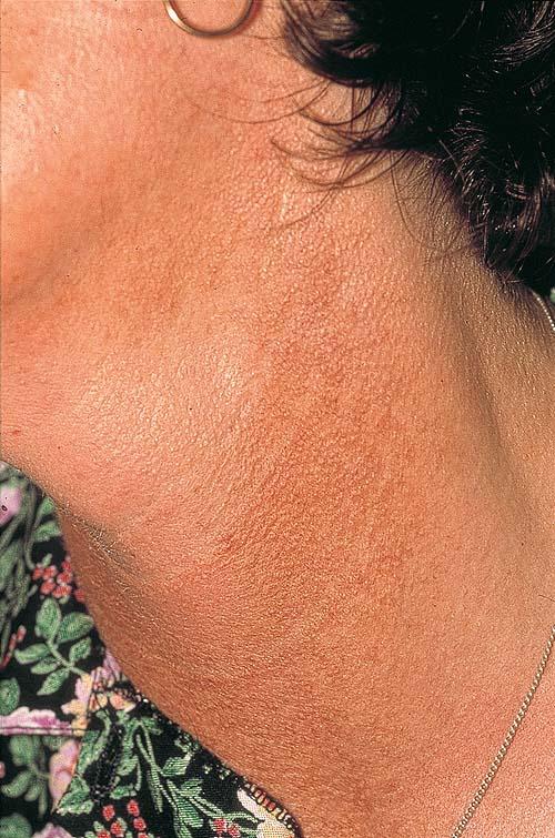 Poikiloderma of Civatte